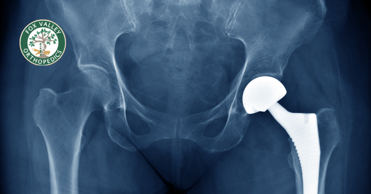 Your Guide to Total Joint Replacement | Fox Valley Orthopedics